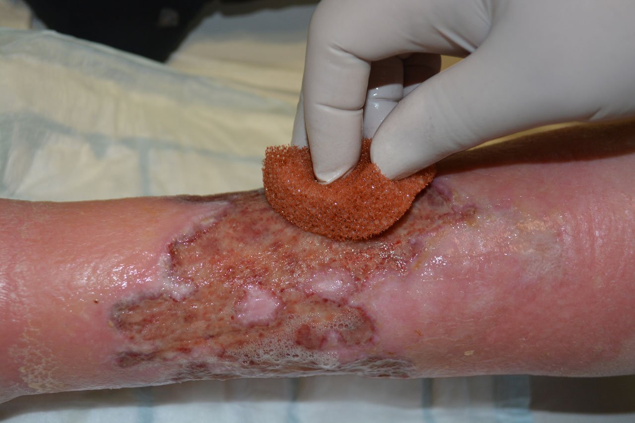 Wundreinigung / Debridement