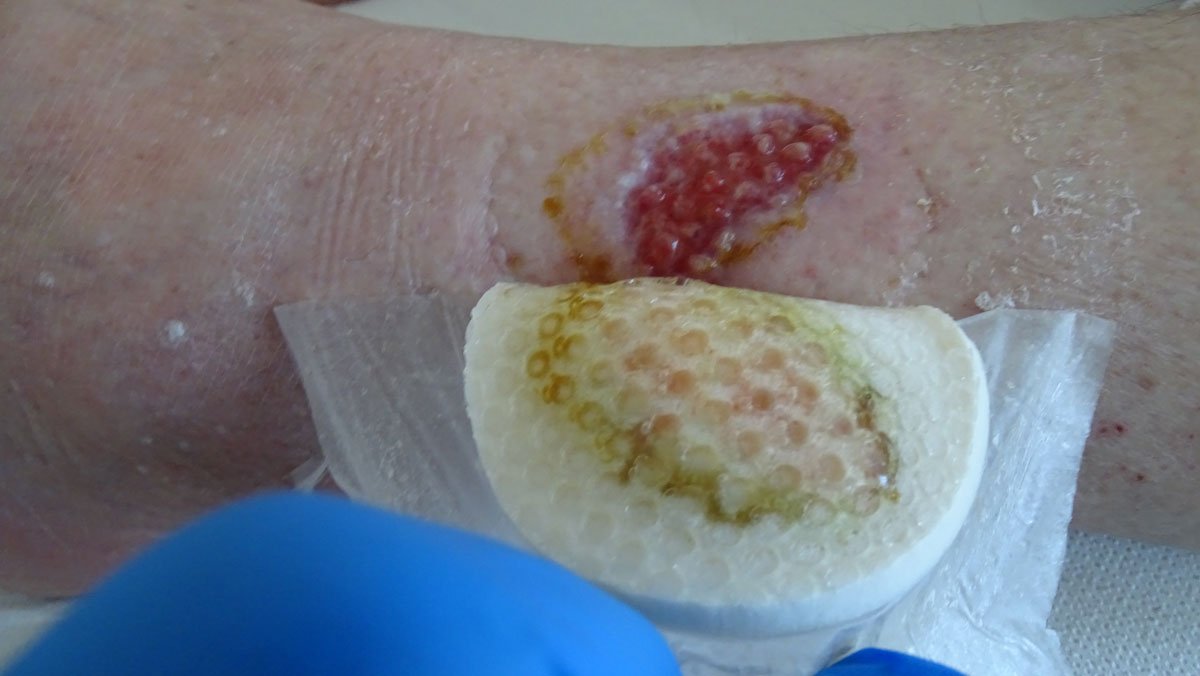 Polyurethan-Schaumverbände -mit Hydrogelbeschichtung-